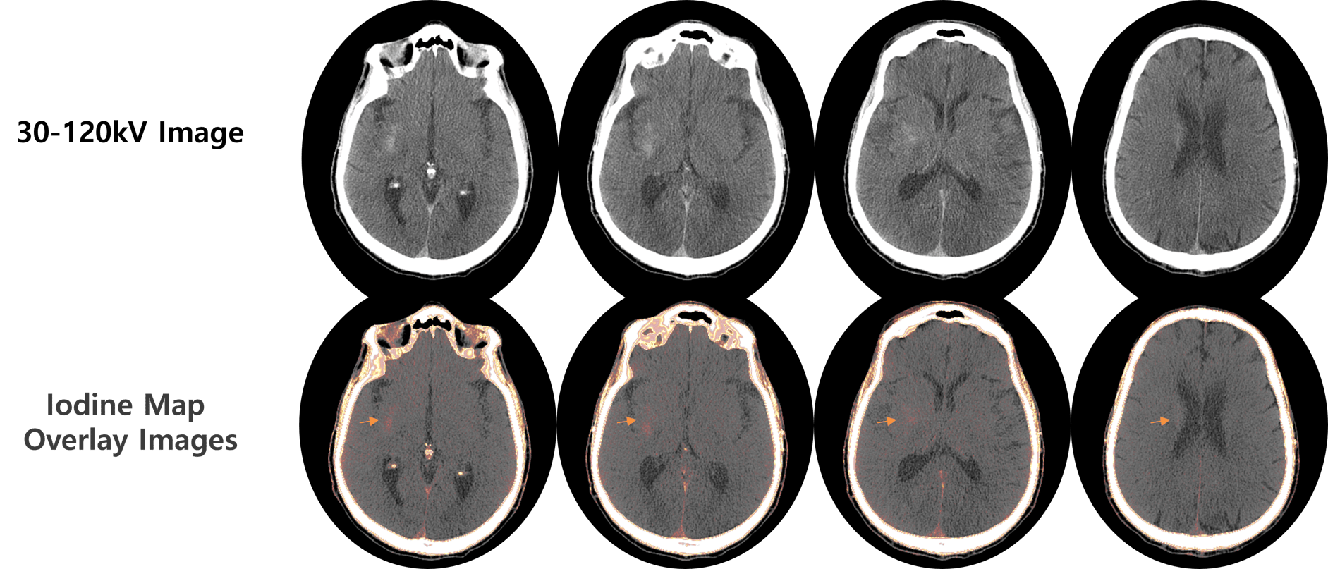 Photon Counting Detectors PCD