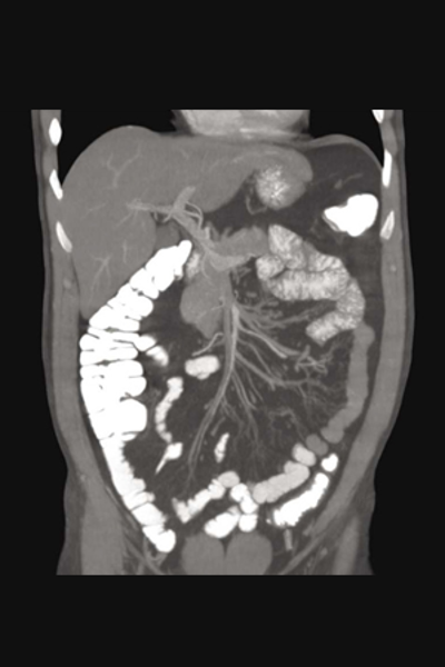 BodyTom® | Portable Full Body CT | NeuroLogica - Samsung